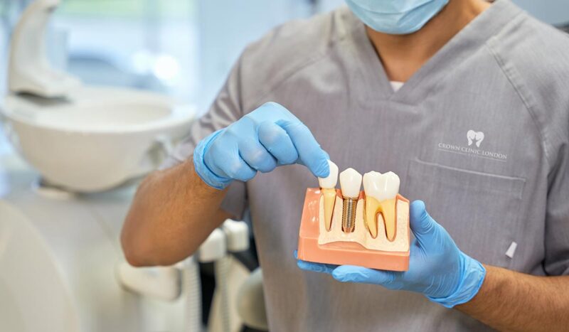 Prosthodontist – Crown Clinic London